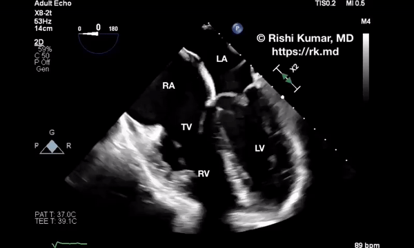 Carcinoid Heart Disease Echocardiography | RK.MD